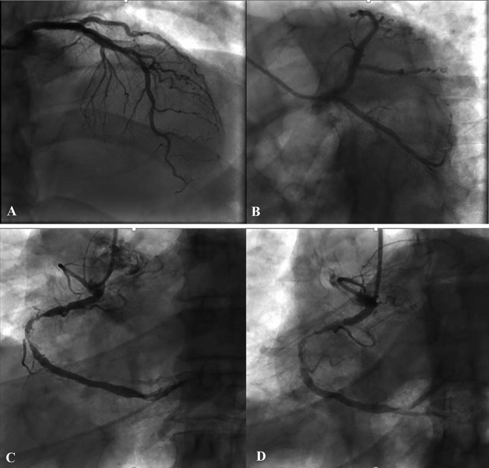 Primary Percutaneous Coronary Intervention | Springer Nature Link ...