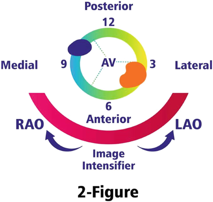 Transcatheter Closure of Aortic Paravalvular Leakage | Springer Nature Link
