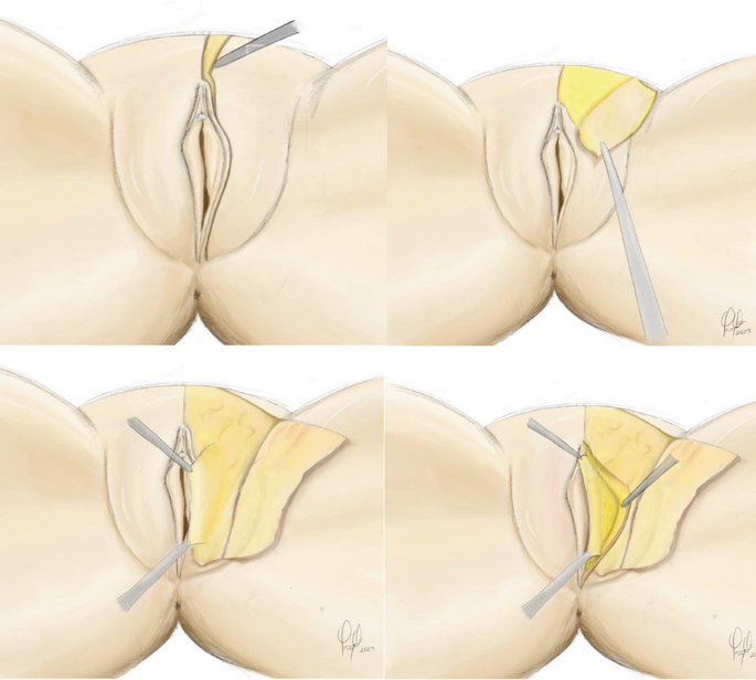 Labia Majora Anatomy | SpringerLink