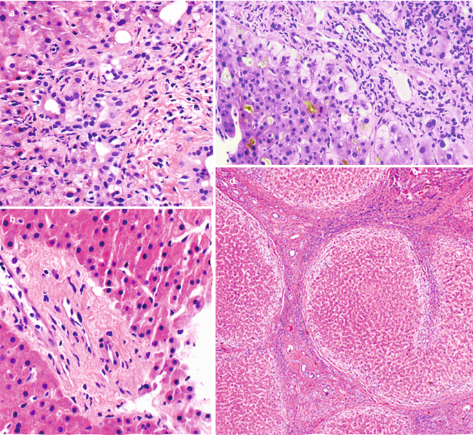 Adult Cholestatic and Bile Duct Diseases | Springer Nature Link
