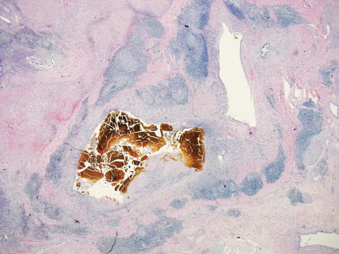 Adult Cholestatic and Bile Duct Diseases | Springer Nature Link