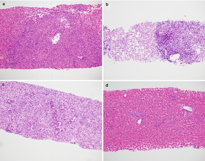 Lymphoma/Leukemia with Liver Involvement | SpringerLink