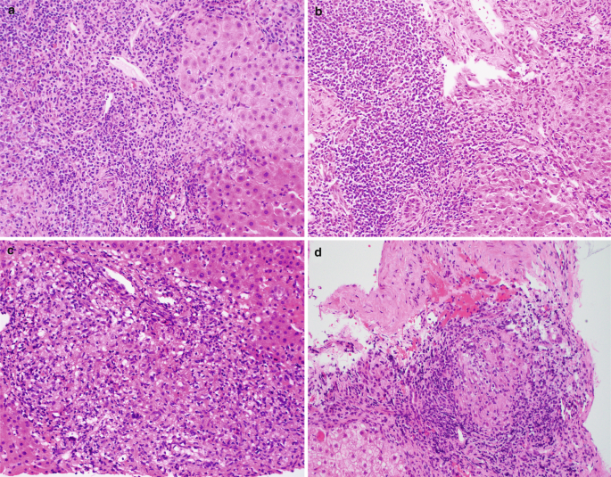 Lymphoma/Leukemia with Liver Involvement | SpringerLink
