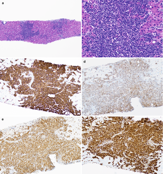Lymphoma/Leukemia with Liver Involvement | SpringerLink