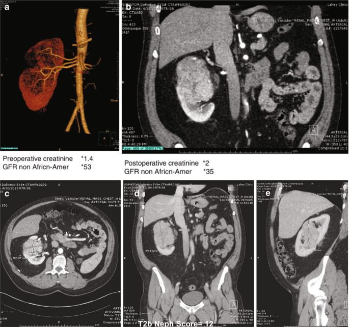 The Surgical Approaches to Renal Masses and Their Impact on ...