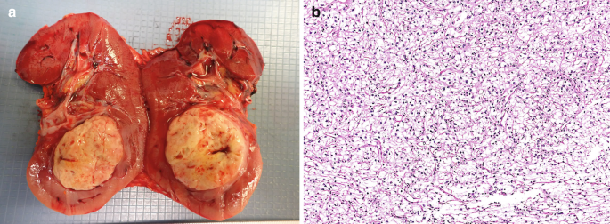 Pathology of Renal Cell Carcinoma | SpringerLink