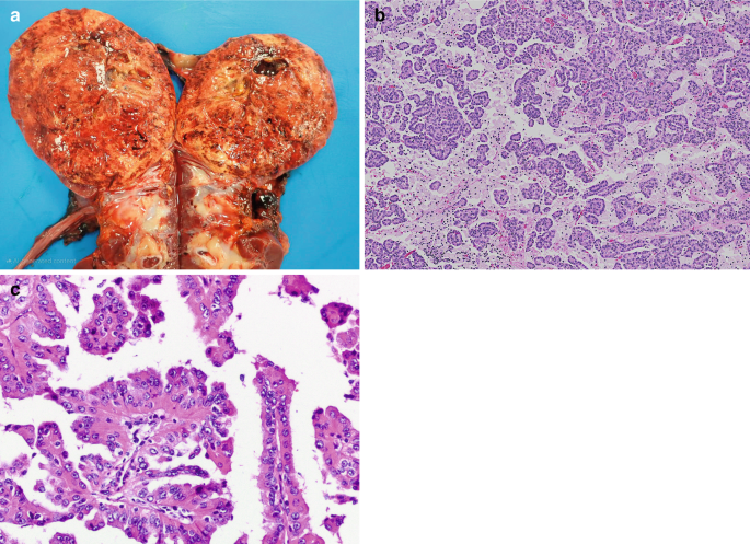 Pathology of Renal Cell Carcinoma | SpringerLink