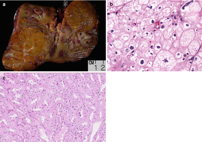 Pathology of Renal Cell Carcinoma | SpringerLink