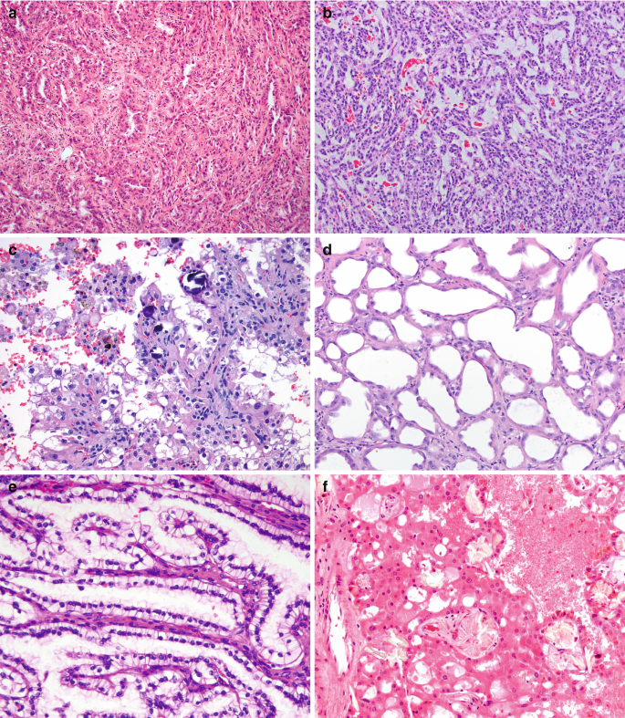 Pathology of Renal Cell Carcinoma | SpringerLink