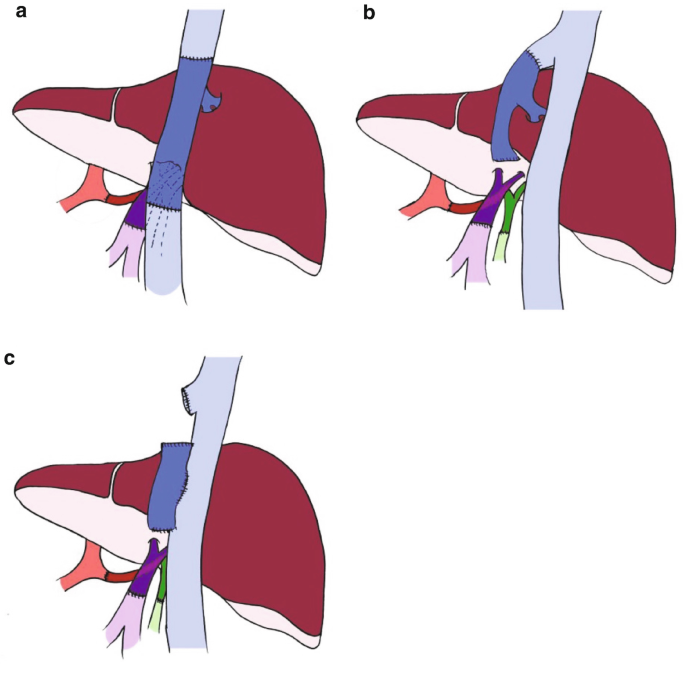 Primary Care of the Adult Liver Transplant Recipient | SpringerLink