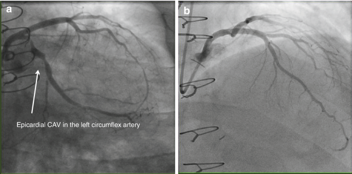 Primary Care of the Adult Heart Transplant Recipient | SpringerLink