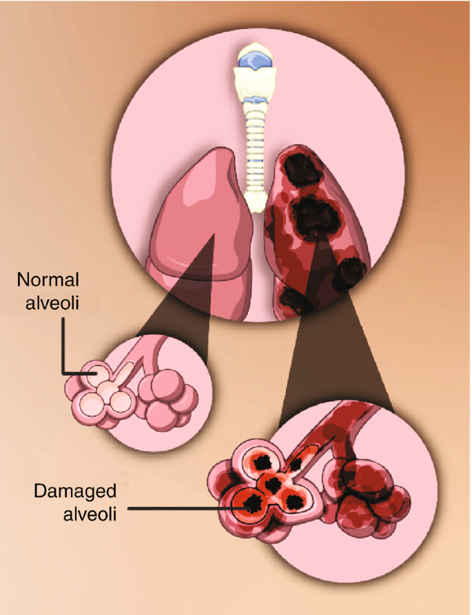Short of Breath | SpringerLink