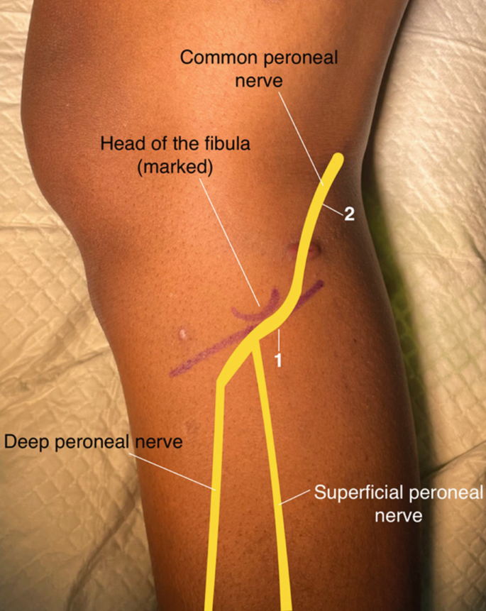 Peripheral Nerves - Lower Limb | SpringerLink
