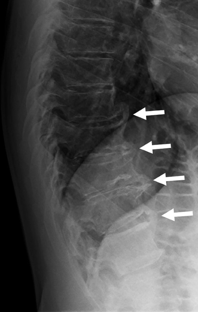 Pitfalls in Diffuse Idiopathic Skeletal Hyperostosis | Springer Nature Link