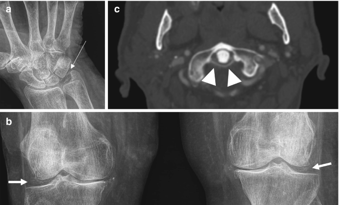 Pitfalls in Crystal Arthropathies | SpringerLink