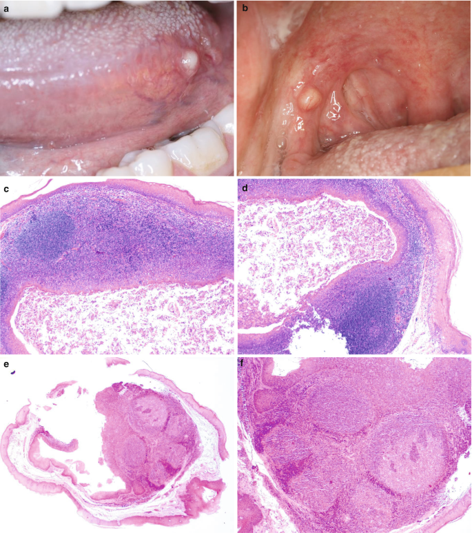 Lymphoid Hyperplasias in the Oral Cavity | Springer Nature Link