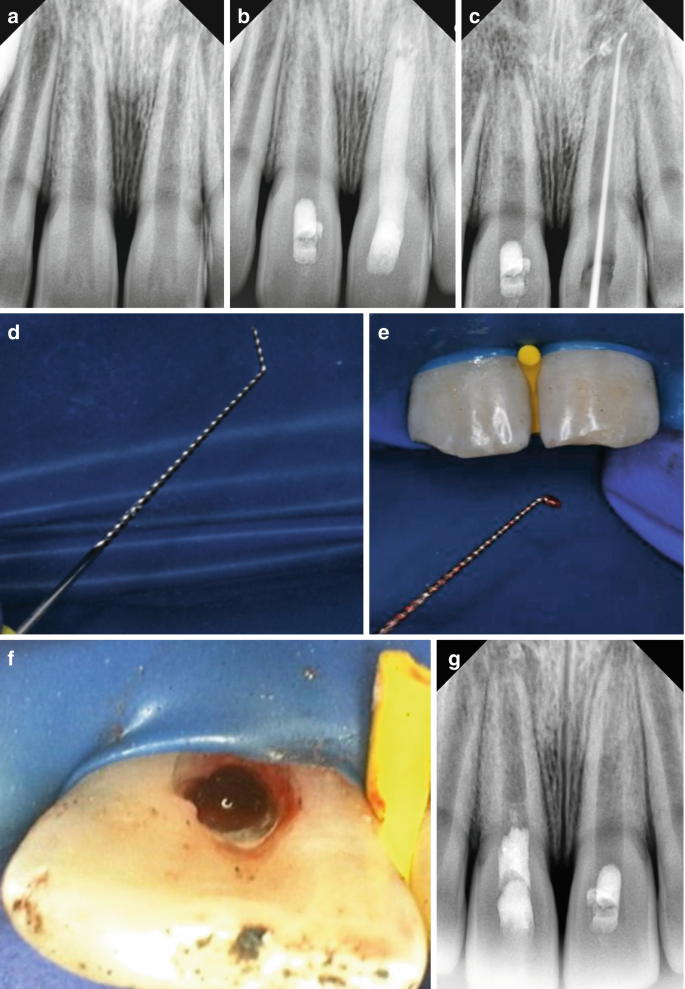 Managing the Immature Tooth: Apexogenesis, Apexification, and ...