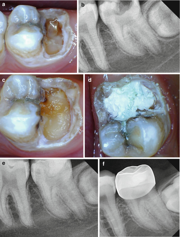 Managing the Immature Tooth: Apexogenesis, Apexification, and ...