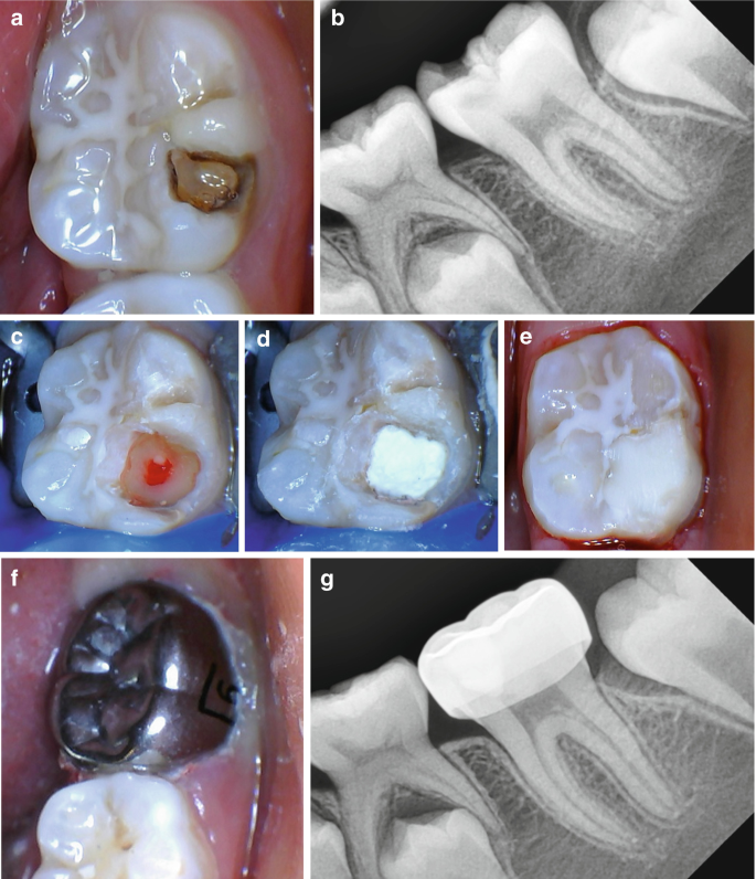 Managing the Immature Tooth: Apexogenesis, Apexification, and ...