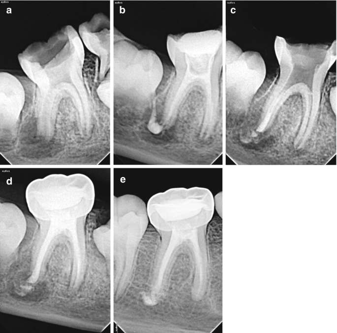 Managing the Immature Tooth: Apexogenesis, Apexification, and ...