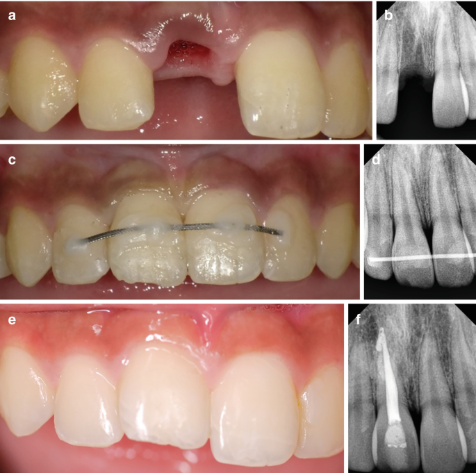 Consequences and Management of Traumatic Dental Injuries in the ...