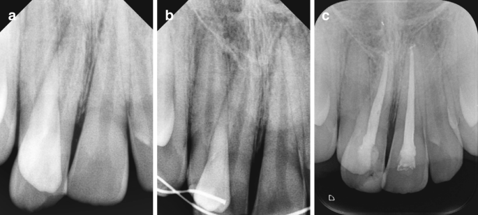 Consequences and Management of Traumatic Dental Injuries in the ...