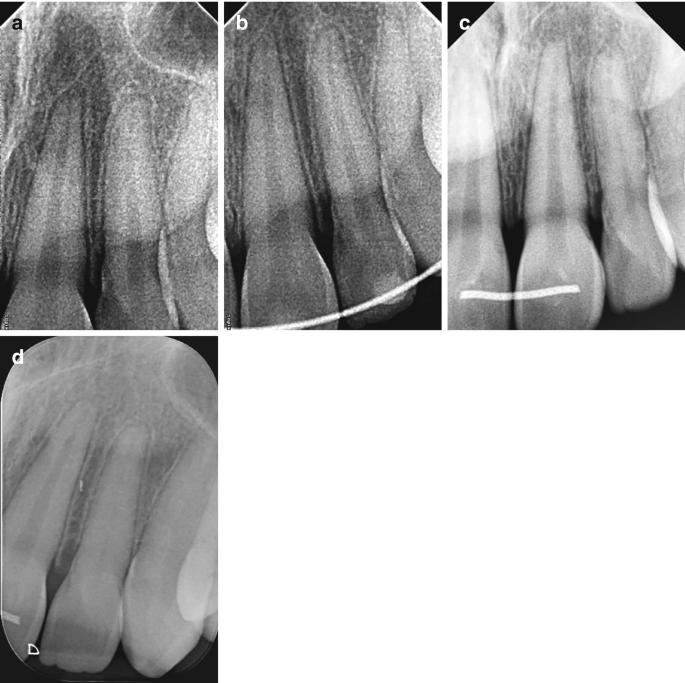 Consequences and Management of Traumatic Dental Injuries in the ...