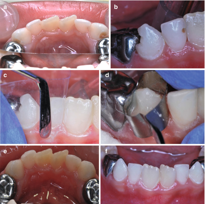 Direct Restorations | Springer Nature Link