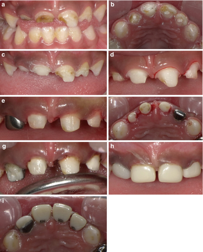 Preformed Crowns in Pediatric Dentistry: Clinical Considerations and ...