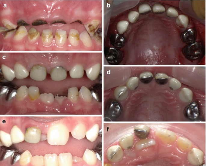 Preformed Crowns in Pediatric Dentistry: Clinical Considerations and ...