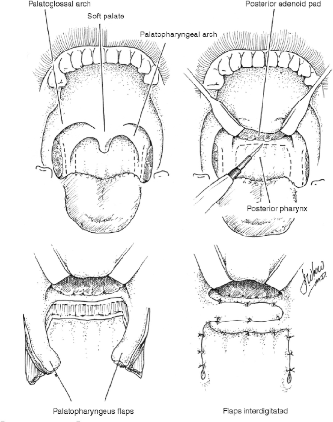 Velopharyngeal Dysfunction | SpringerLink