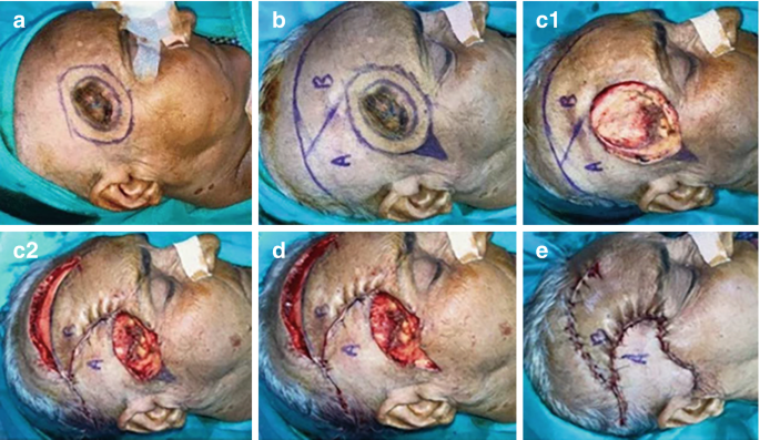 Scalp Reconstruction | SpringerLink
