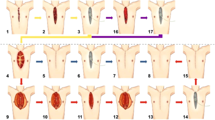 Chest Reconstruction | SpringerLink