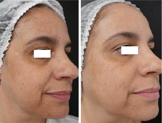 Lasers in Plastic Surgery | SpringerLink