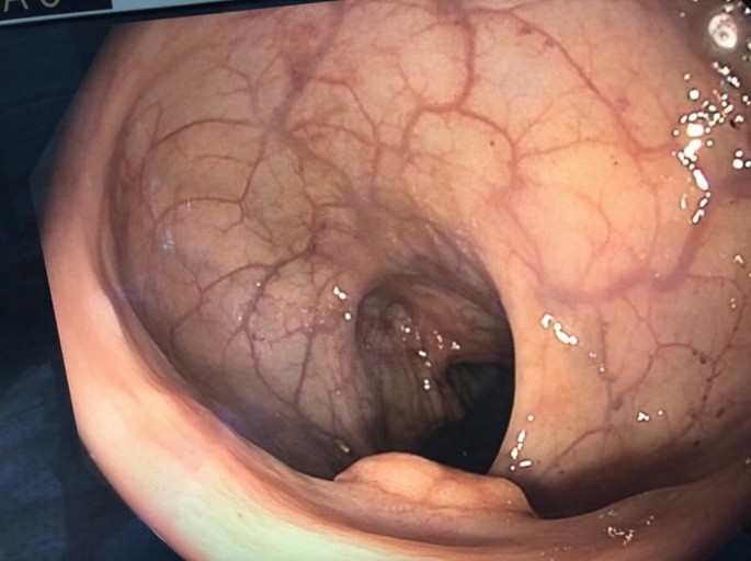 What Color Is the Colorectal Mucosa as Seen Through a Colonoscope ...
