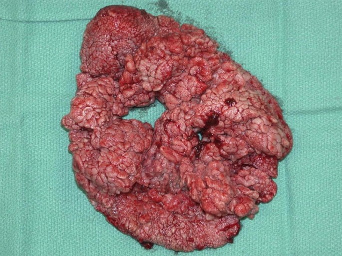 What Is a Buschke–Lowenstein Tumor, and How Do You Treat It? | SpringerLink