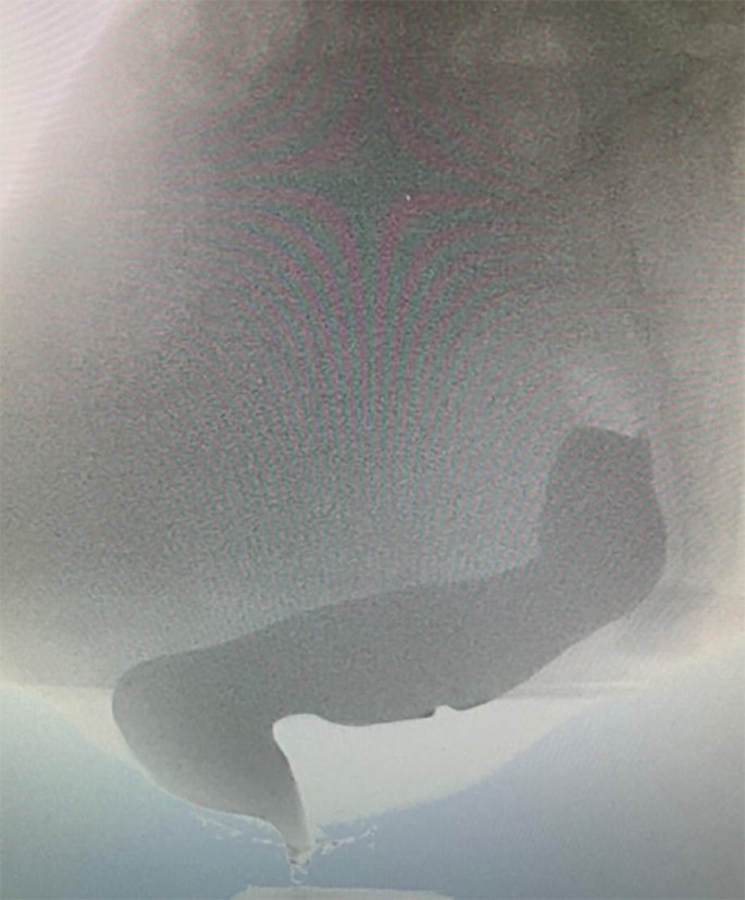 What Is a Rectocele? How Common Is It? How Does It Happen? What Should ...