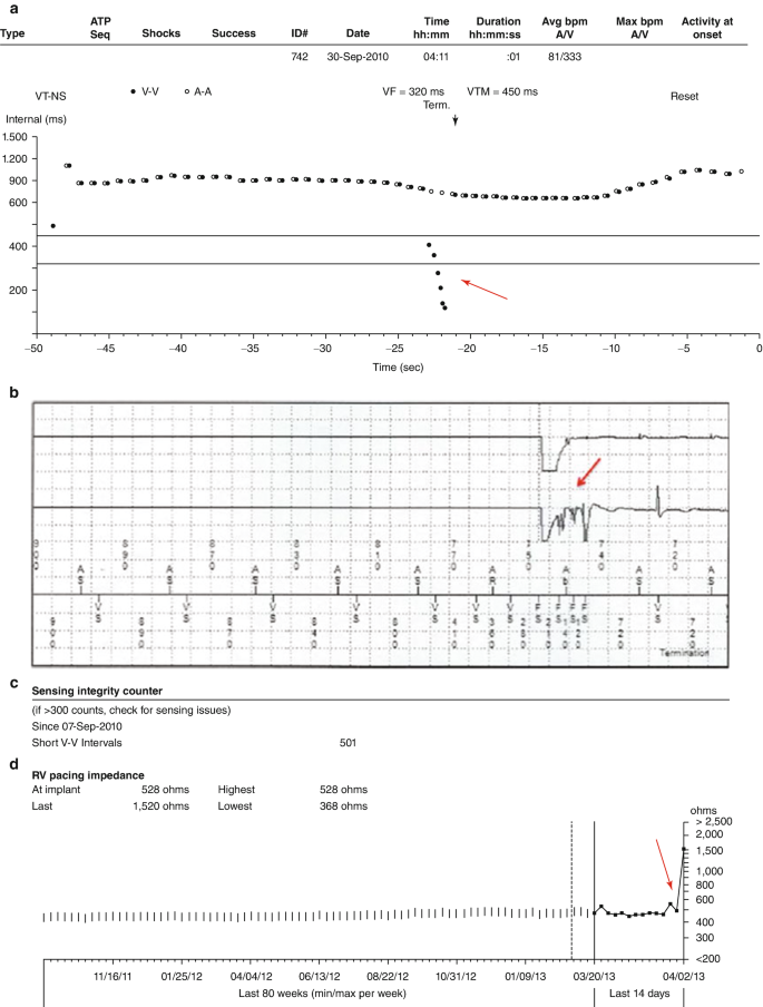 Indications and Outcomes of PPM and ICD Placement | SpringerLink