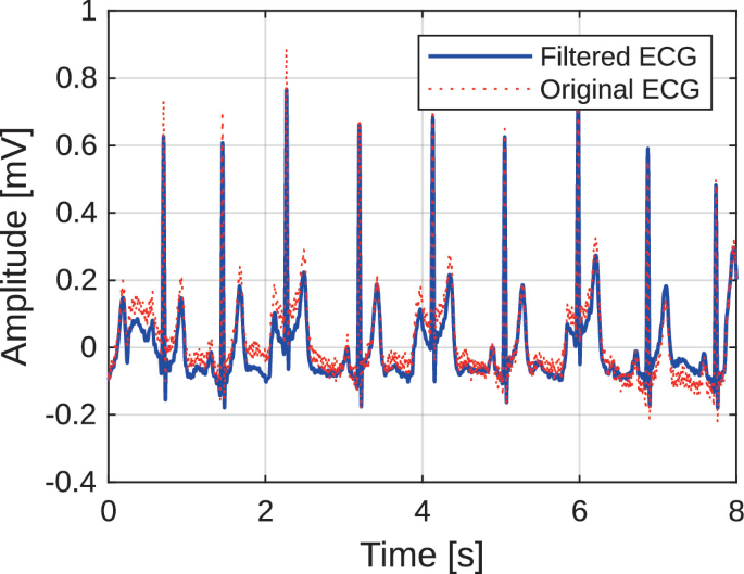 Streamlined Signal Processing for Electrocardiogram ECG | SpringerLink