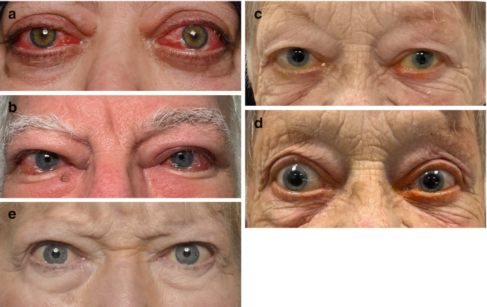 Signs and Symptoms of TED | Springer Nature Link (formerly SpringerLink)