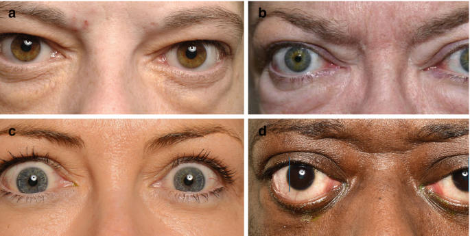 Signs and Symptoms of TED | Springer Nature Link (formerly SpringerLink)