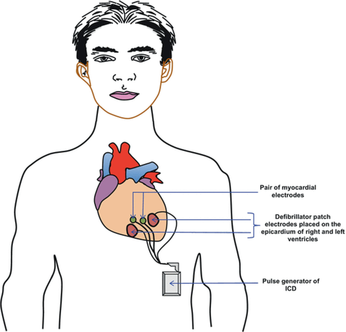 Implantable Cardioverter Defibrillators | Springer Nature Link