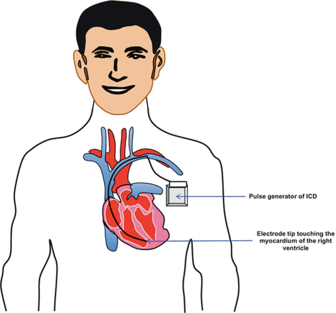 Implantable Cardioverter Defibrillators | Springer Nature Link