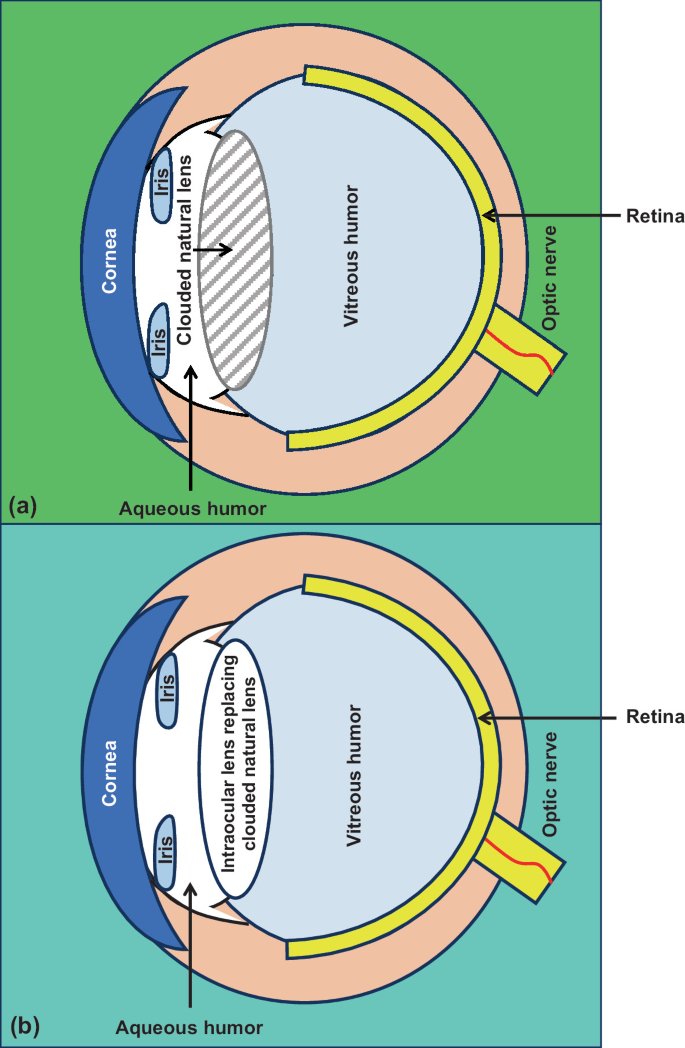 Smart Contact Lenses and Eye Implants | Springer Nature Link (formerly ...