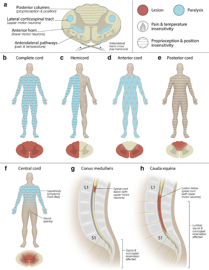 Spinal Cord Injuries: General Information, Classification, Etiology ...