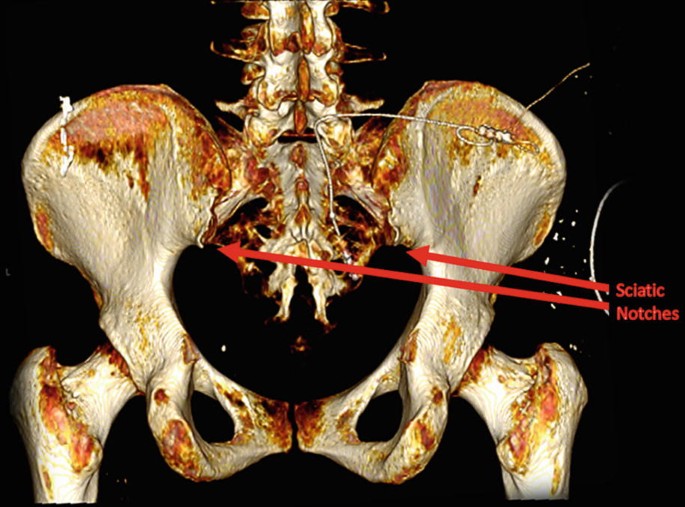Sacral Neuromodulation: Detailed Surgical Technique and Clinical ...