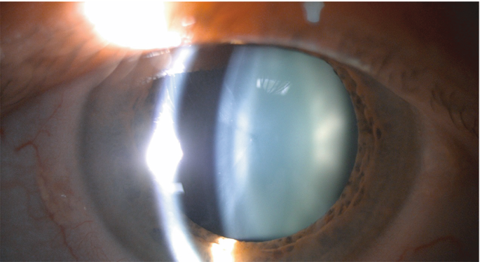 Aging of the Human Lens: When Should It Be Substituted? | Springer ...