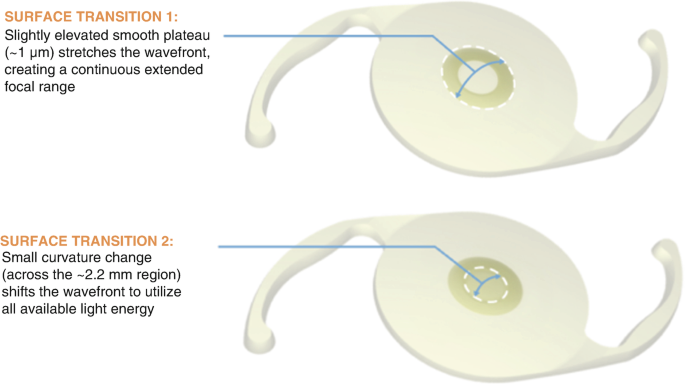 Vivity Extended Depth-of-Focus Intraocular Lens | Springer Nature Link