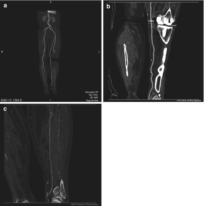 Acute Thrombosis of the Popliteal Aneurysm | SpringerLink