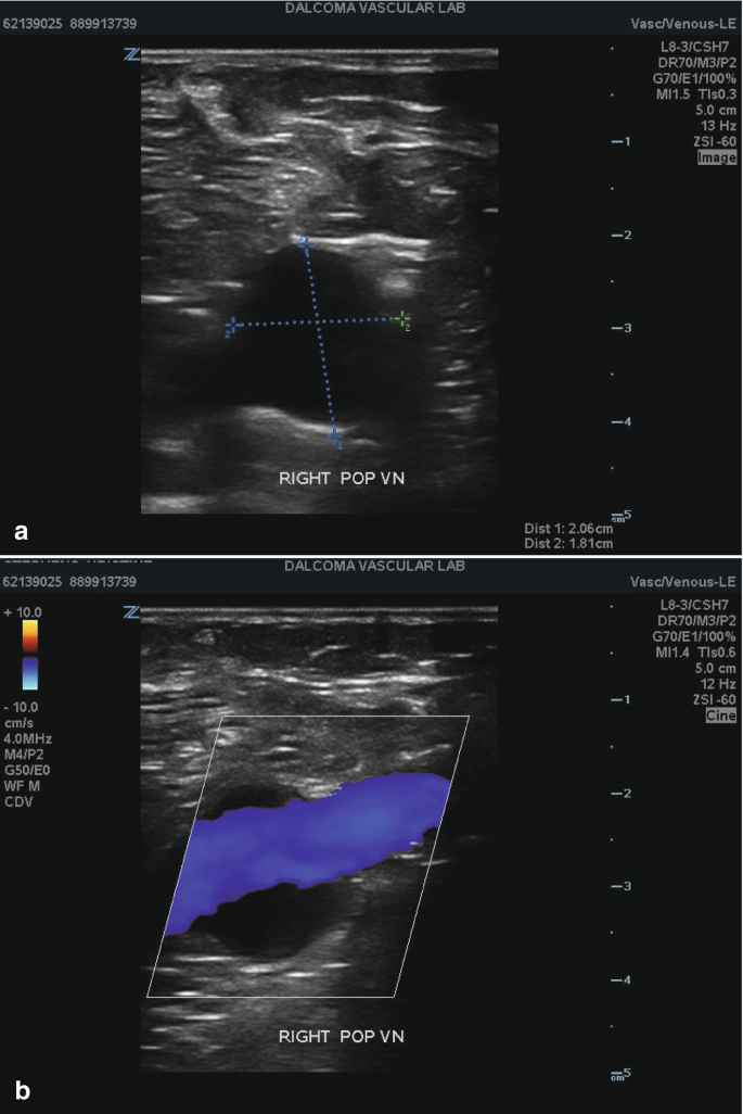 Popliteal Venous Aneurysm | Springer Nature Link
